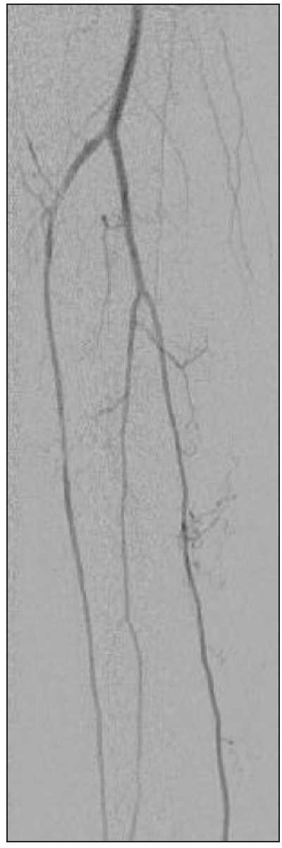 Transbrachial Access for Stenting of Femoropopliteal Lesions ...