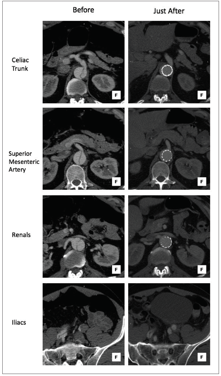 TEVAR Alone Versus the STABLE Technique for Acute Complicated TBAD ...