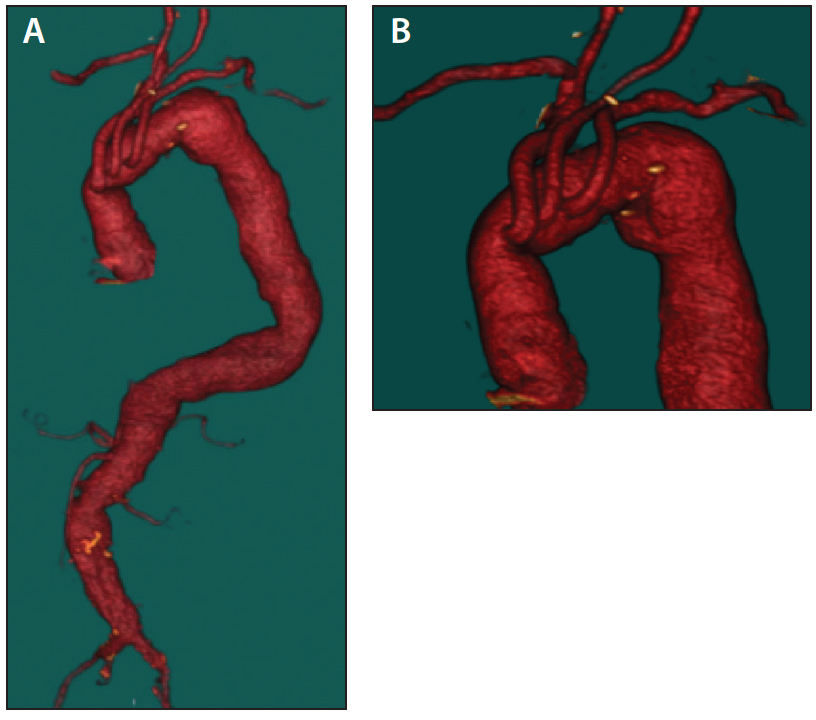 E-xtra DESIGN ENGINEERING: Inner Branch Technology - Endovascular Today