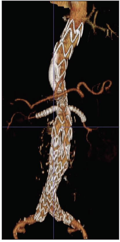 E-xtra DESIGN ENGINEERING: Inner Branch Technology - Endovascular Today