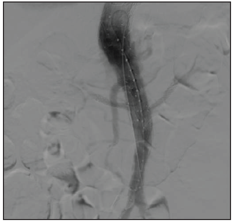 E-xtra DESIGN ENGINEERING: Inner Branch Technology - Endovascular Today