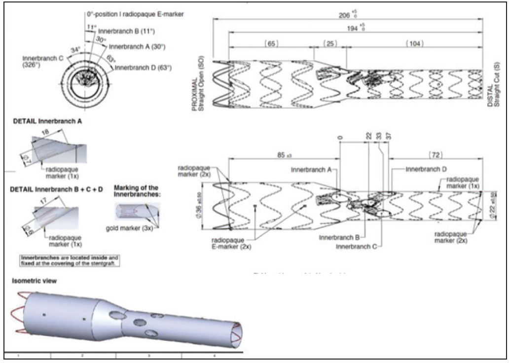 E-xtra DESIGN ENGINEERING: Inner Branch Technology - Endovascular Today