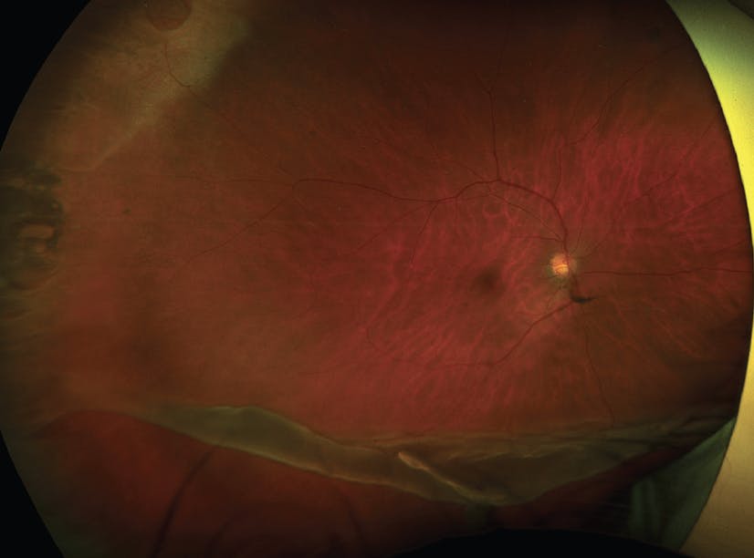 Managing a Giant Retinal Tear Without Vitrectomy - Retina Today