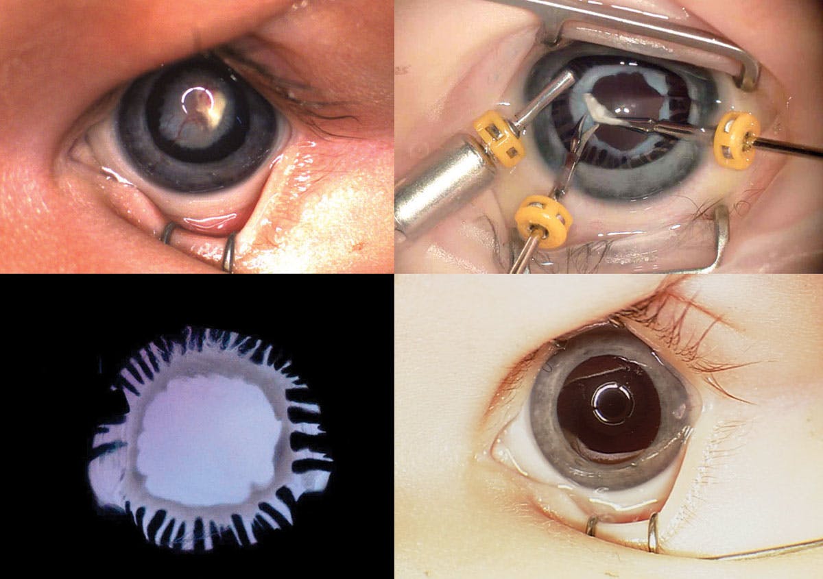 Surgical Options for PFV Plaque Dissection - Retina Today