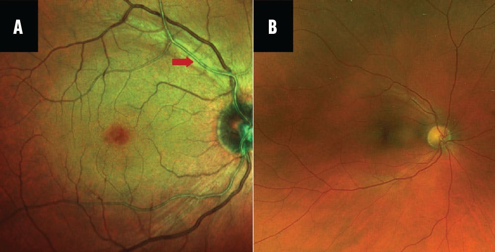 Retinal Biomarkers of Systemic Disease: Part Two - Retina Today