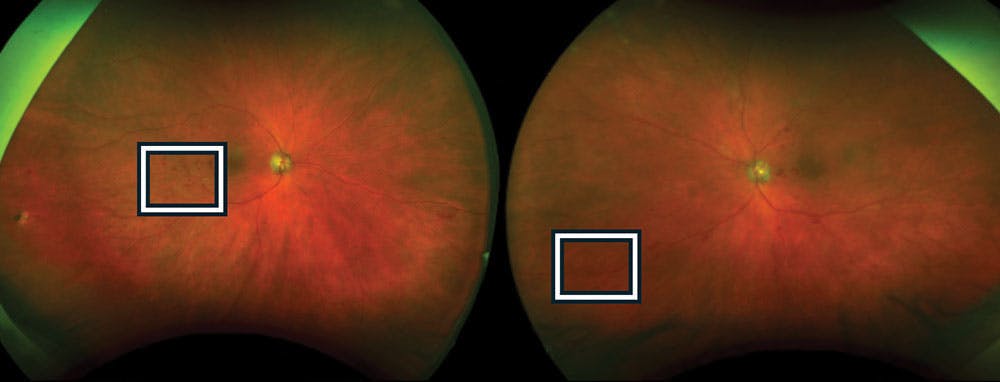 Progress in AI for Retinal Image Analysis - Retina Today