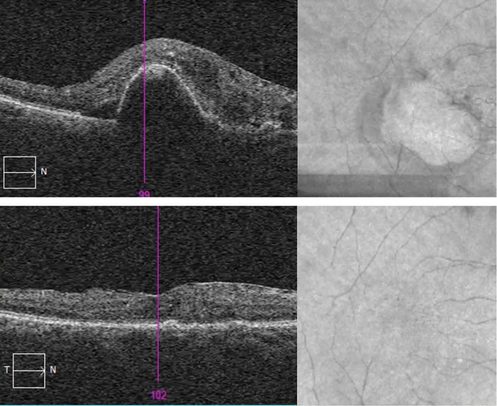 Wet AMD Therapies in the Pipeline - Retina Today