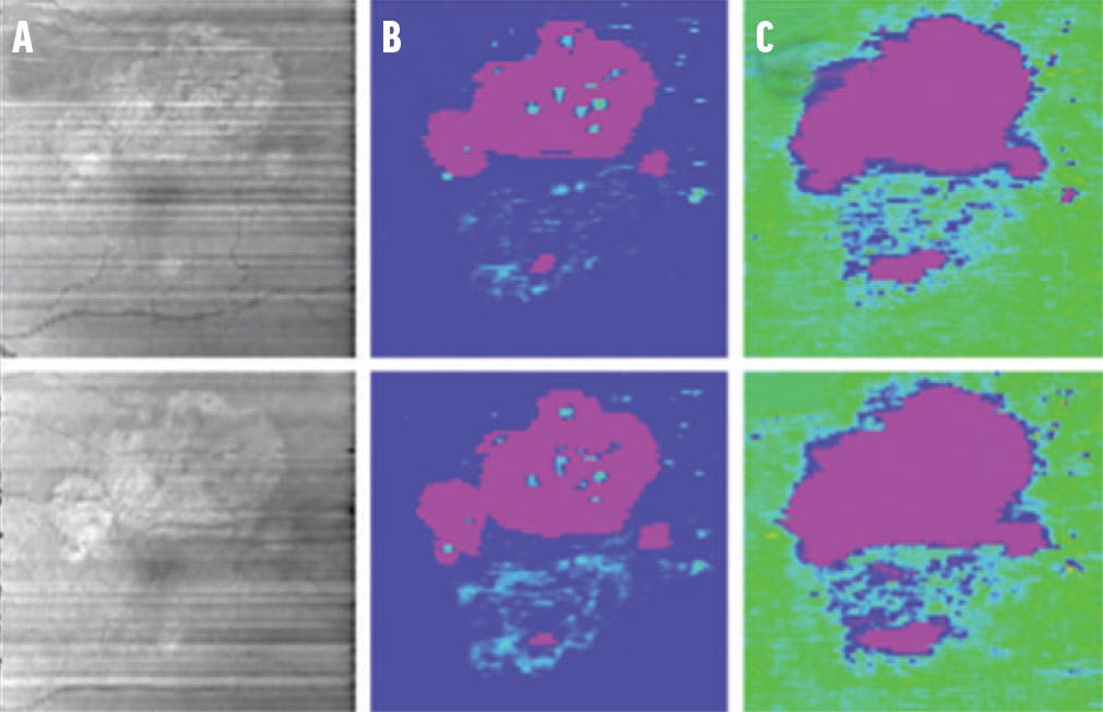 A Closer Look at Ellipsoid Zone Attenuation - Retina Today