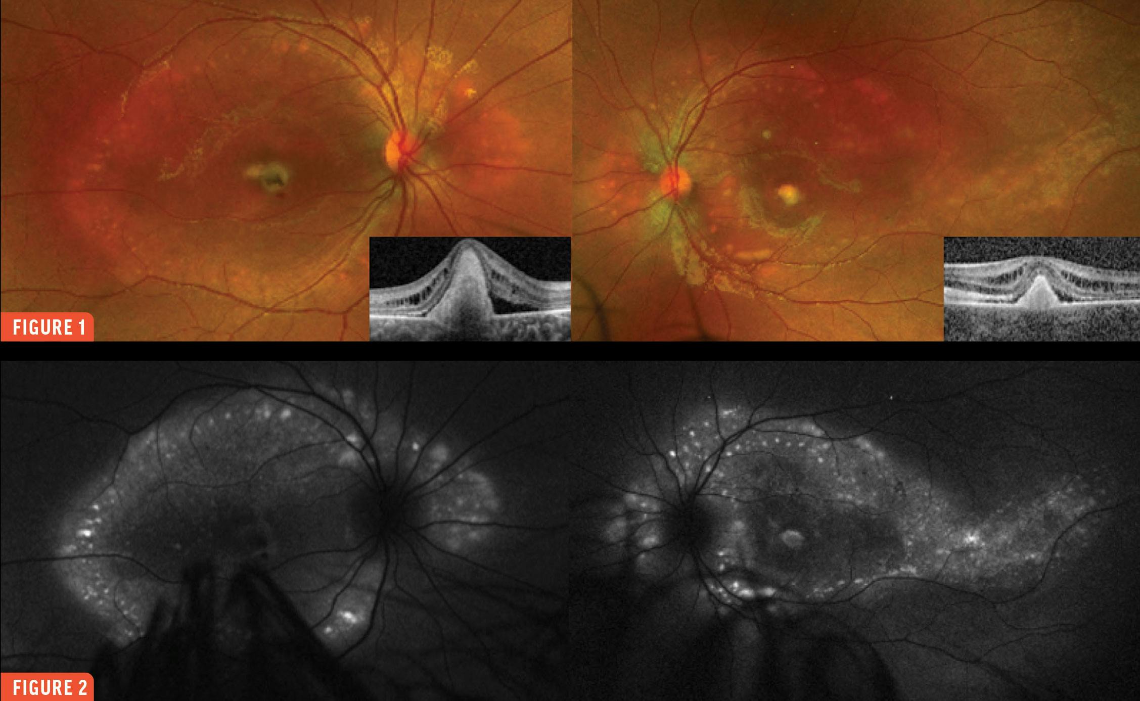 Multigenerational Autosomal Recessive Best Disease - Retina Today