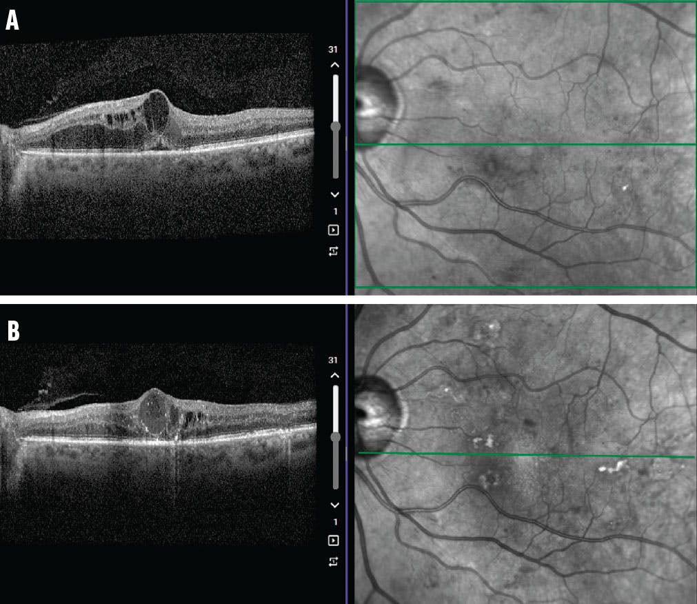 Advances in Therapy for Diabetic Eye Disease - Retina Today