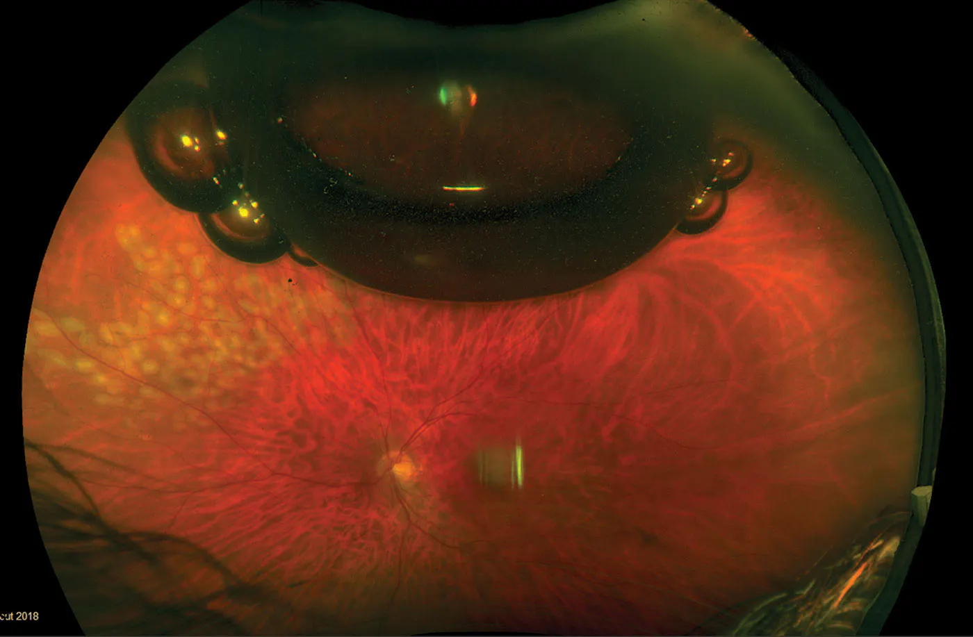 The Need for Novel Intraocular Tamponade Agents - Retina Today