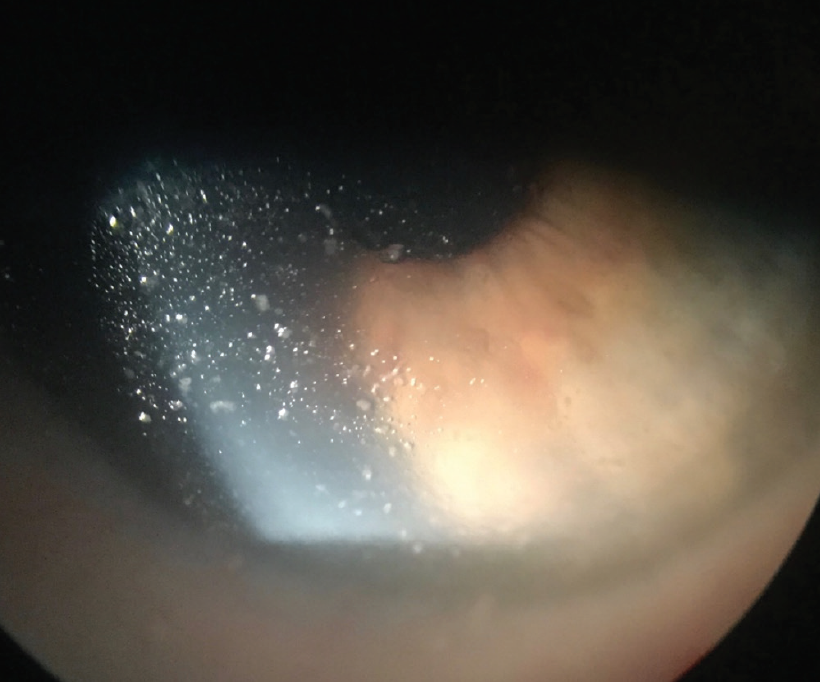 Treating Ocular Surface Disease With Scleral Lenses - Modern Optometry