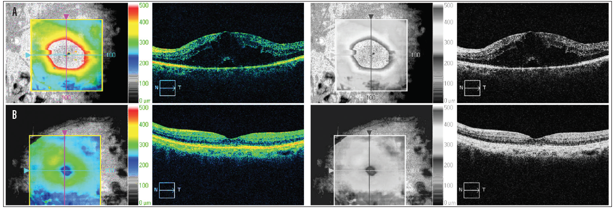 Medical Management of Diabetic Retinopathy - Modern Optometry