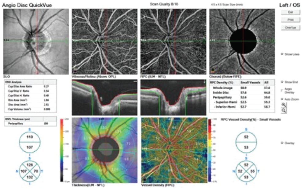 OCT Angiography for Glaucoma - Modern Optometry