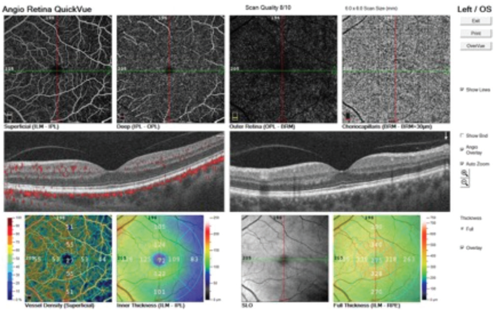 OCT Angiography for Glaucoma - Modern Optometry