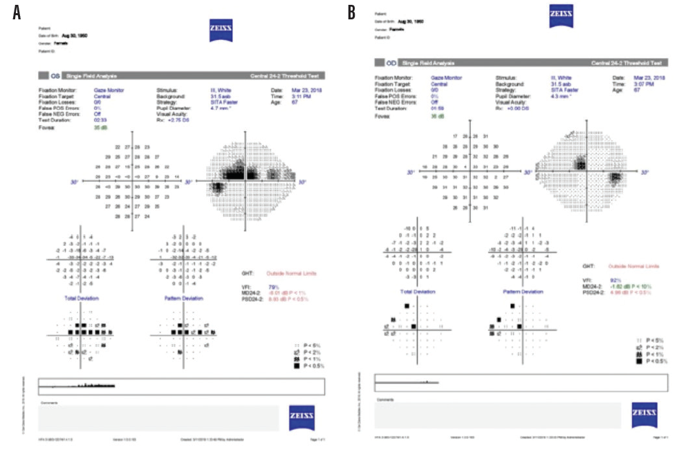 OCT Angiography for Glaucoma - Modern Optometry