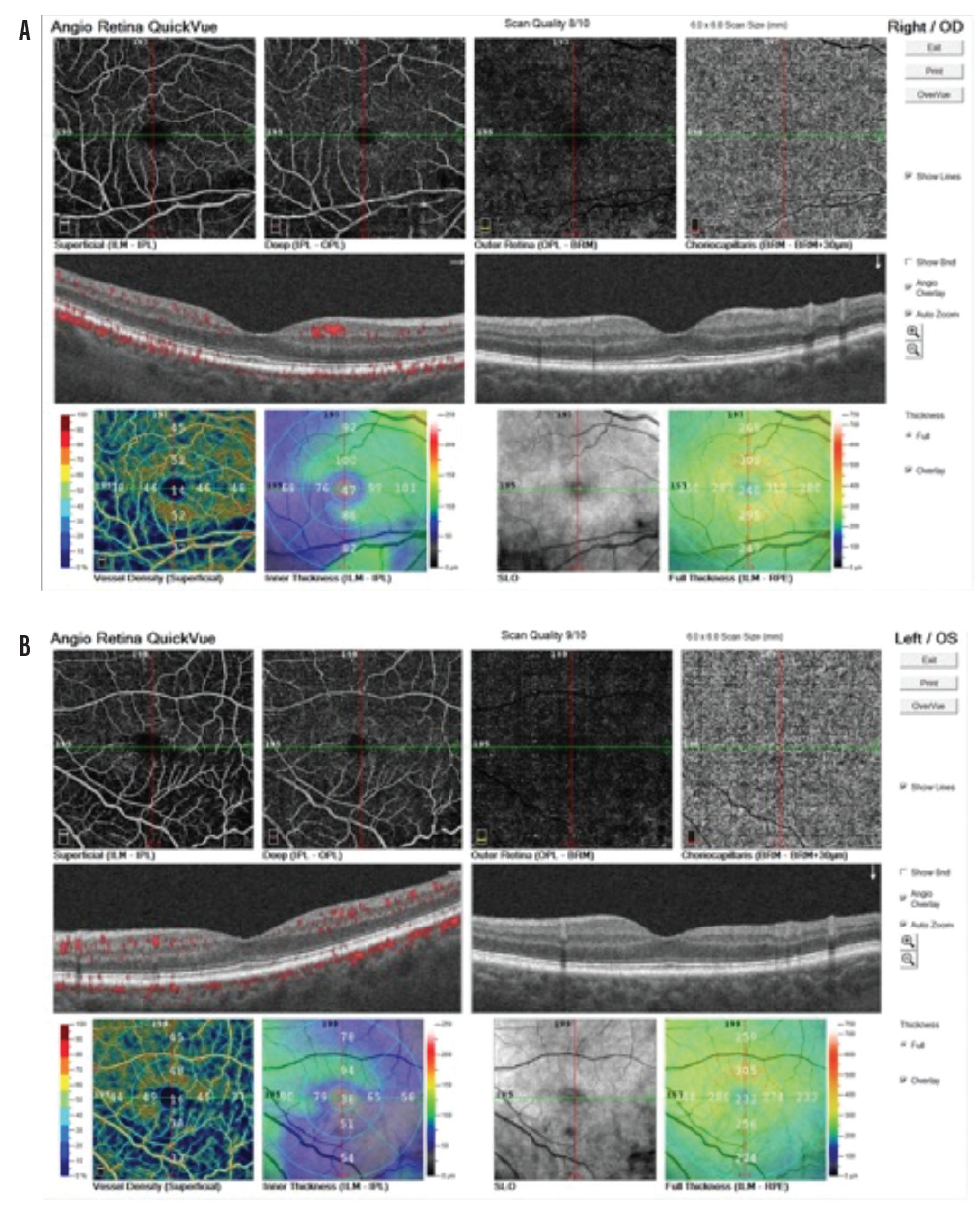 OCT Angiography for Glaucoma - Modern Optometry