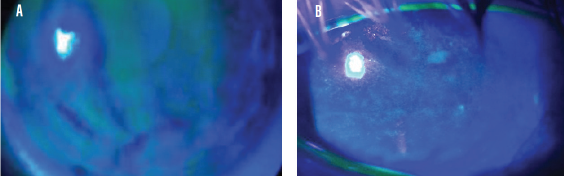 Essentials for Diagnosing OSD - Modern Optometry