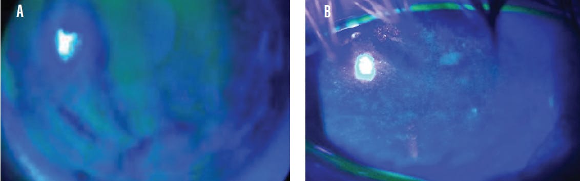 Essentials for Diagnosing OSD - Modern Optometry
