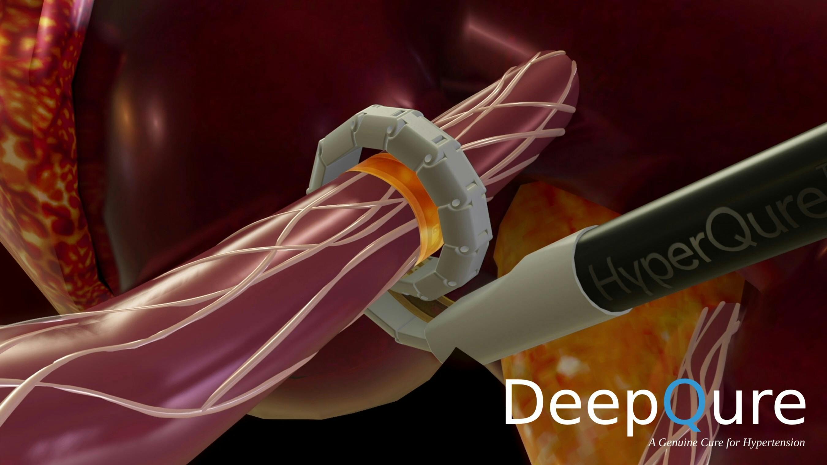 DeepQure Receives IDE Approval for EFS of HyperQure Extravascular RDN ...
