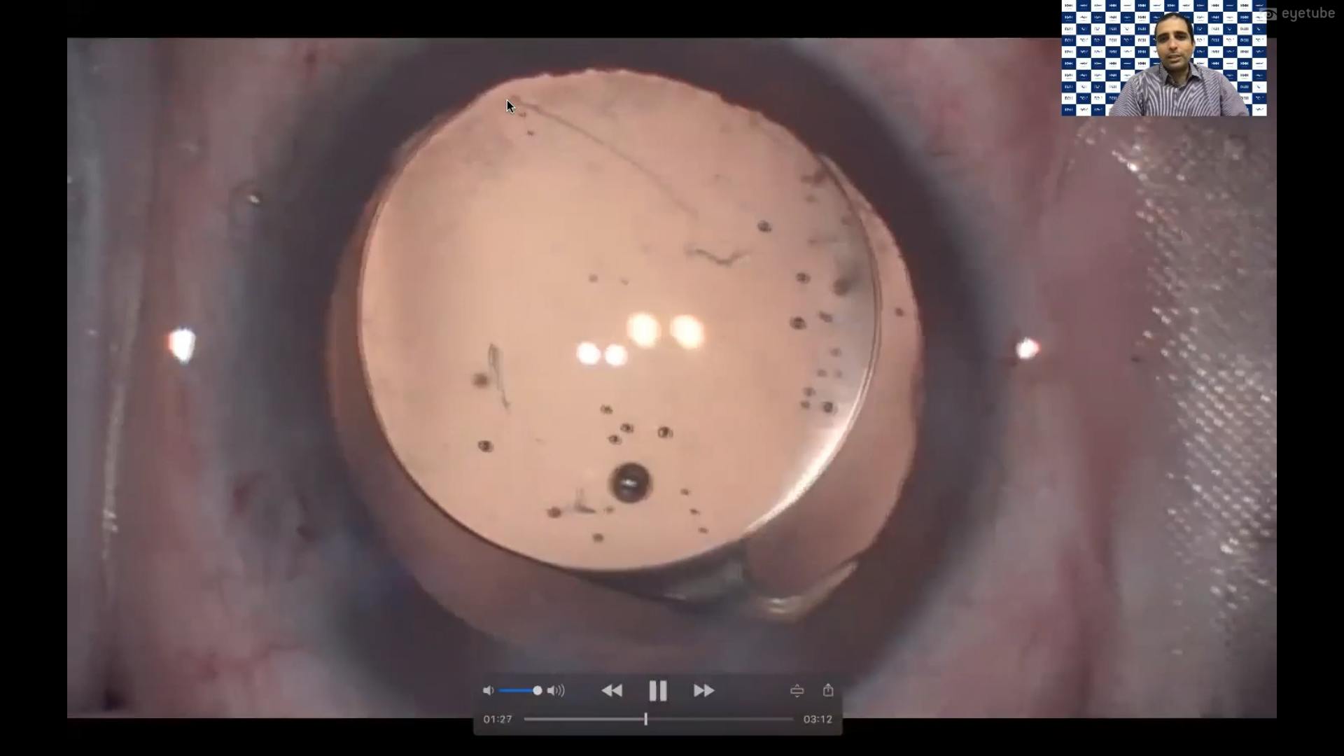 Reverse Capture With Toric IOL - Eyetube