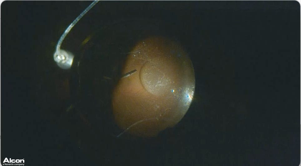 Subretinal PFCL - Eyetube