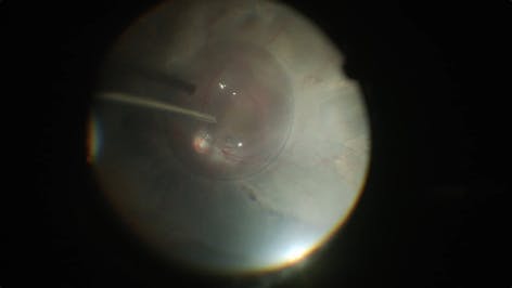 Stickler Syndrome & Perfluoron - Eyetube