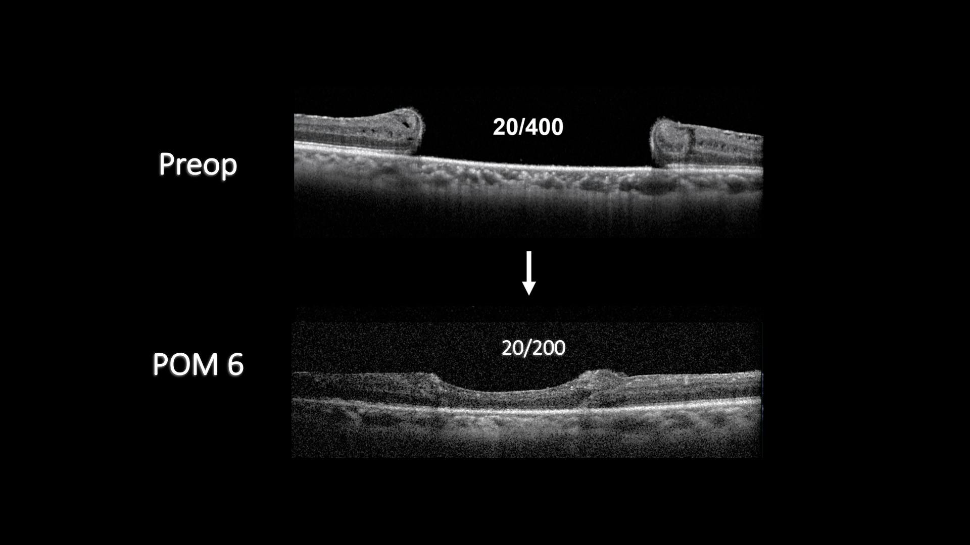 A Complex Case of Cornea Transplant and IOL Exchange - Eyetube