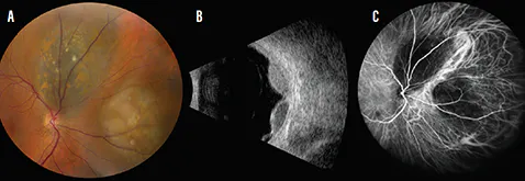 A Rare Presentation of Multifocal Choroidal Melanoma - Retina Today