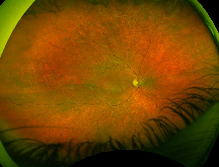 Top IRDs to Watch: Cone and Cone-Rod Dystrophies - Retina Today