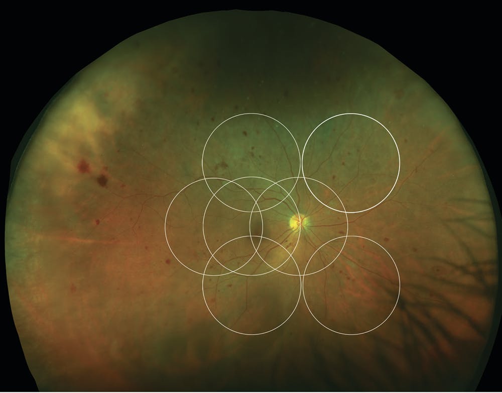 The Role of Peripheral Imaging in Diabetic Retinopathy - Retina Today