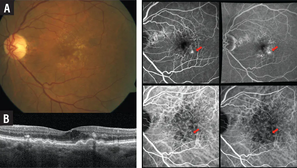 Therapies on the Horizon for Nonexudative AMD - Retina Today
