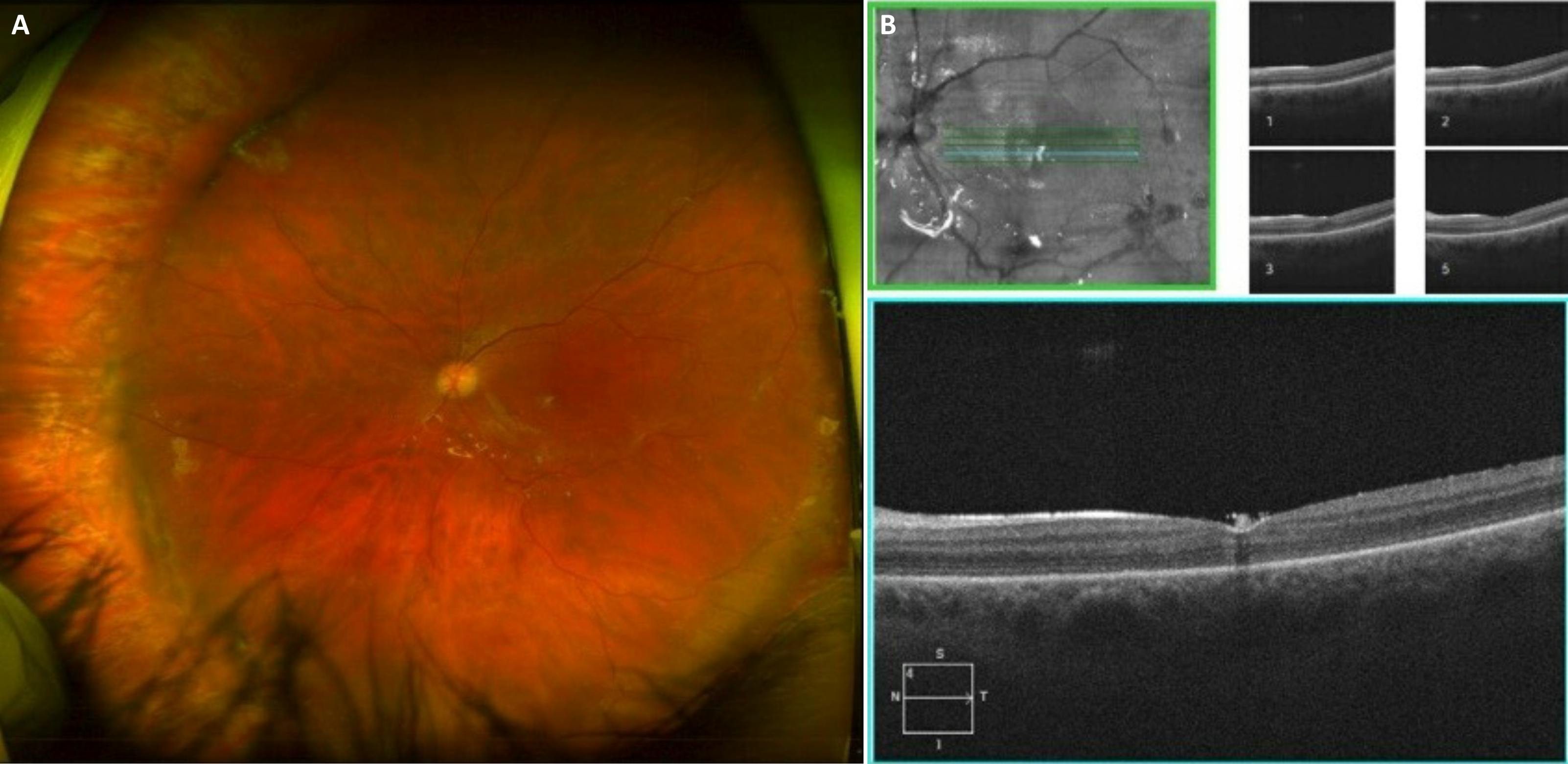 How to Choose the Right Tamponade - Retina Today