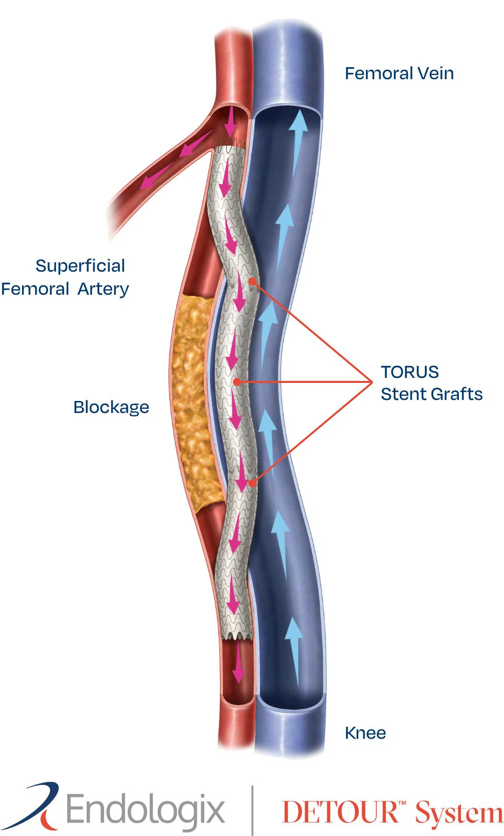 Endologix Detour System Reaches Treatment Milestone - Endovascular Today