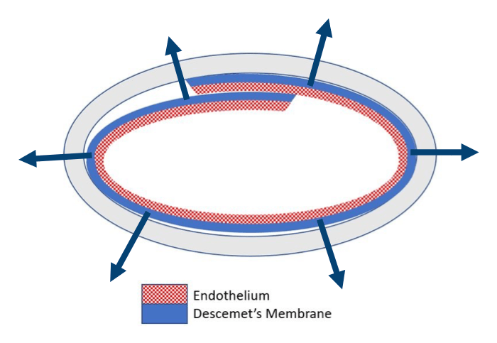 EverSight Launches Preloaded DMEK EndoGlide - Eyewire+