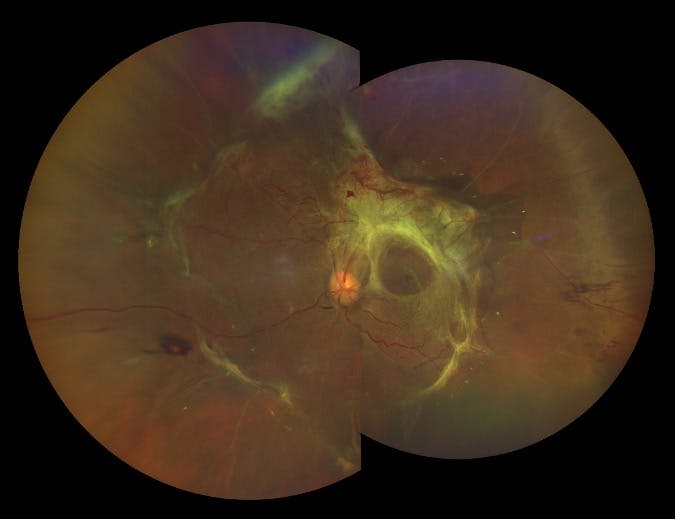 Your Complex TRD Questions Answered - Retina Today