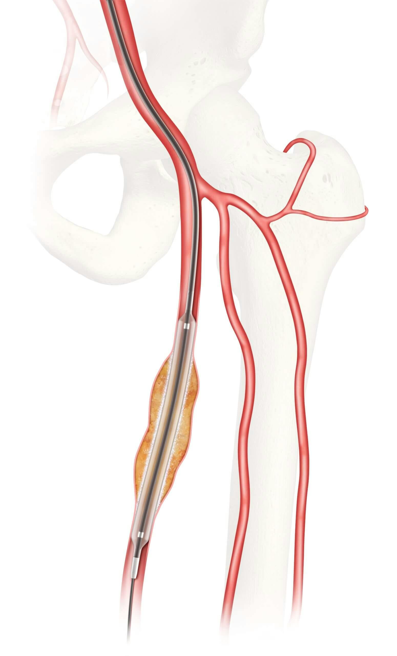 Cook’s Advance Evero 18 Everolimus-Coated Balloon IDE Study Plan ...