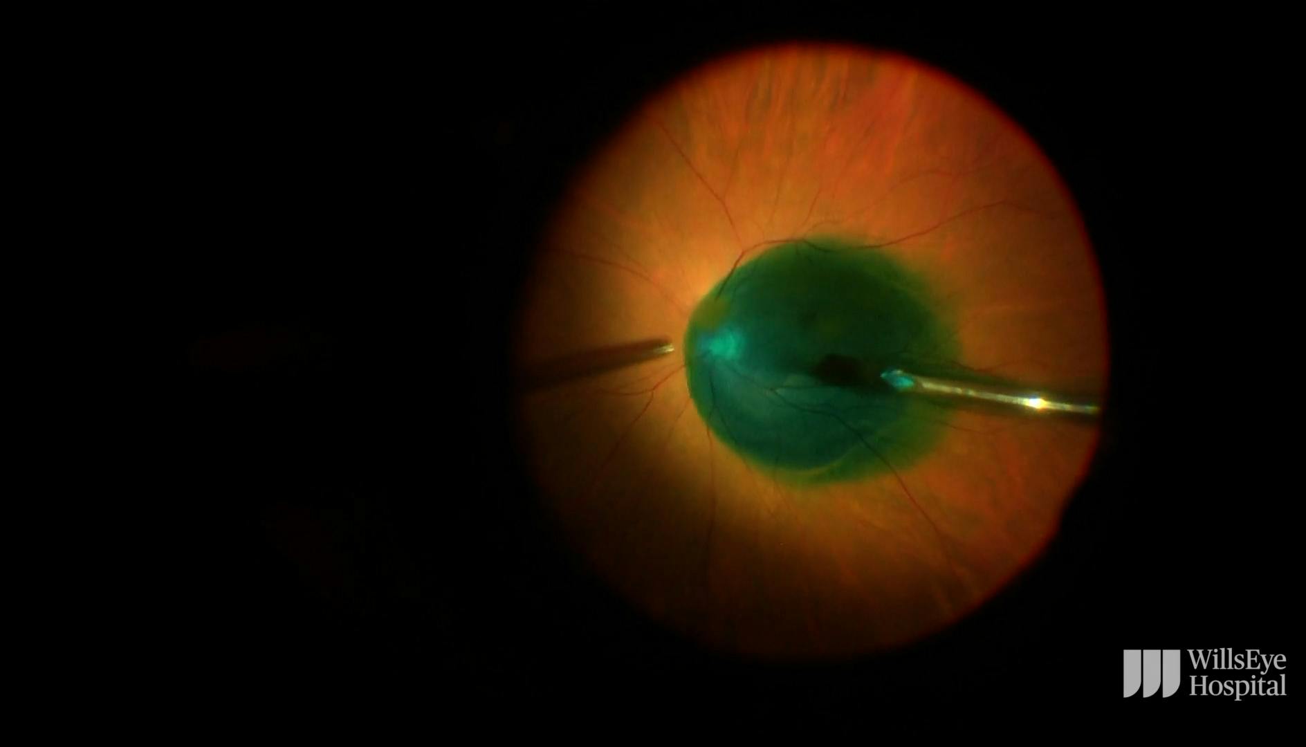 Macular Hole Repair - Eyetube