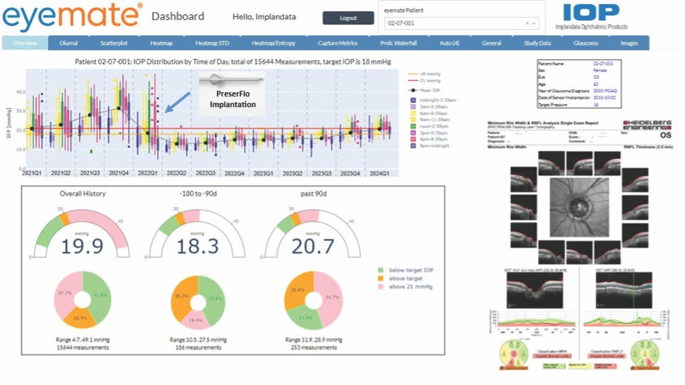 The Eyemate System - Glaucoma Today