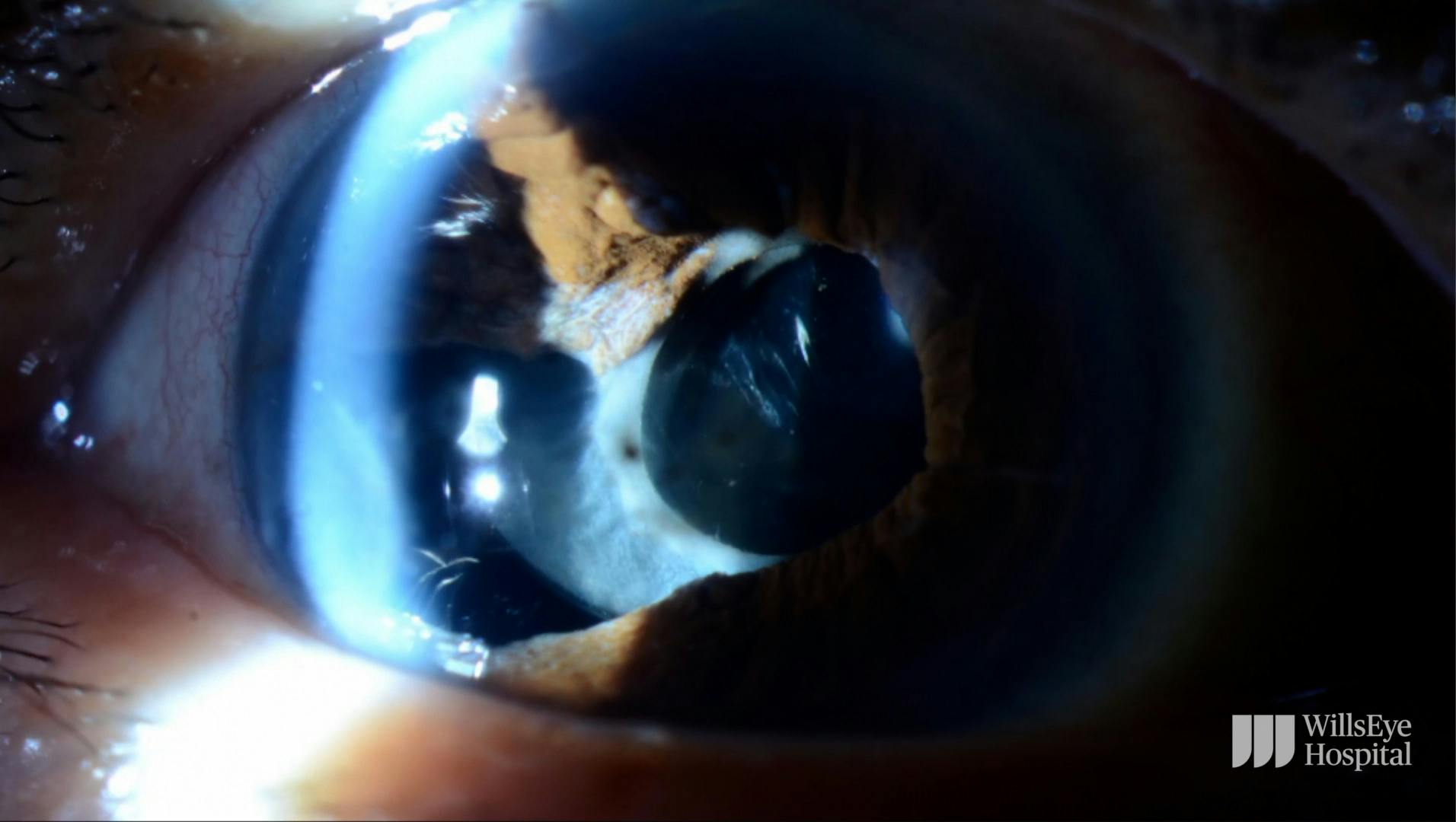 Cornea - Eyetube