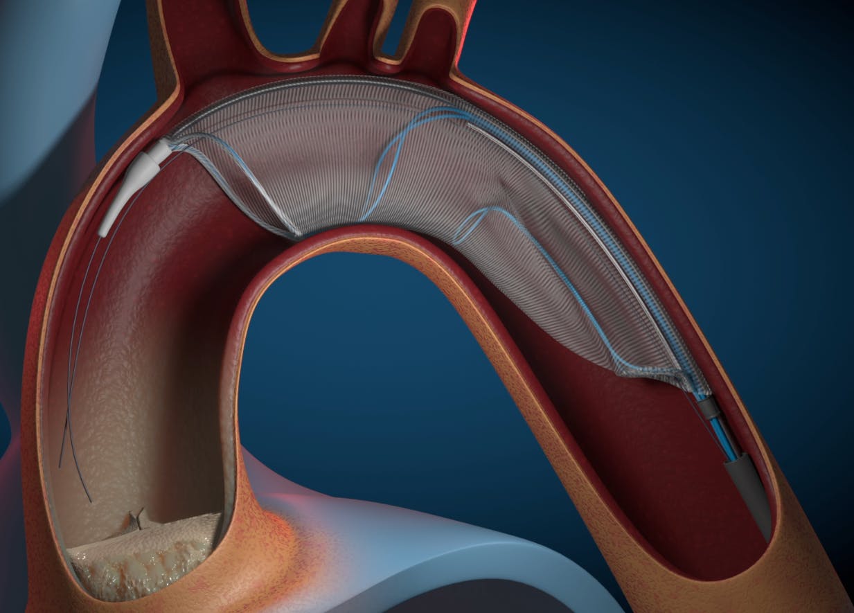 AorticLab’s FLOWer Transcatheter Embolic Protection Device Granted CE ...