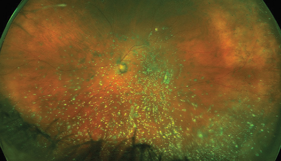 Best Practices on Referring Patients With Symptomatic Vitreous ...