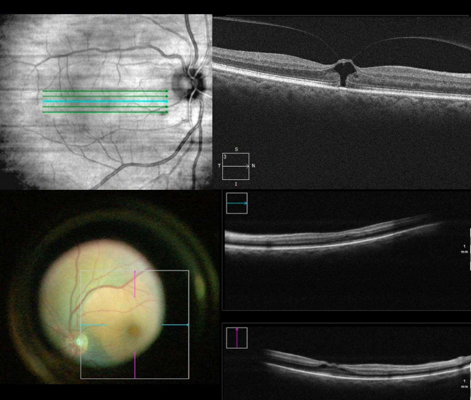 Five Ways OCT Can Enhance Vitreoretinal Surgery - Retina Today