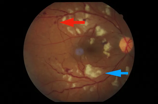 Purtscher-Like Retinopathy: A Warning Sign of Lupus - Retina Today