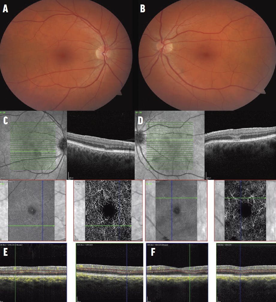 Acute Retinopathy Following Weightlifting Supplement - Retina Today
