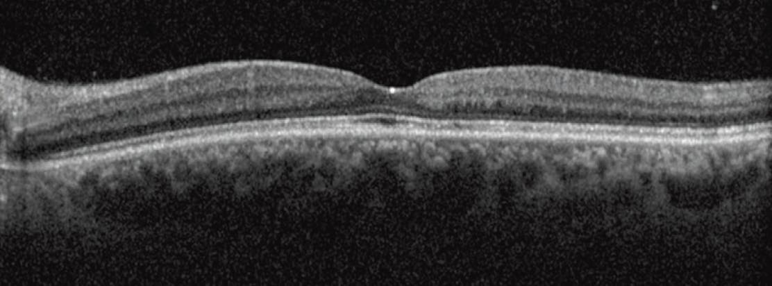 Diagnostic Pearls for MacTel Type 2 - Retina Today