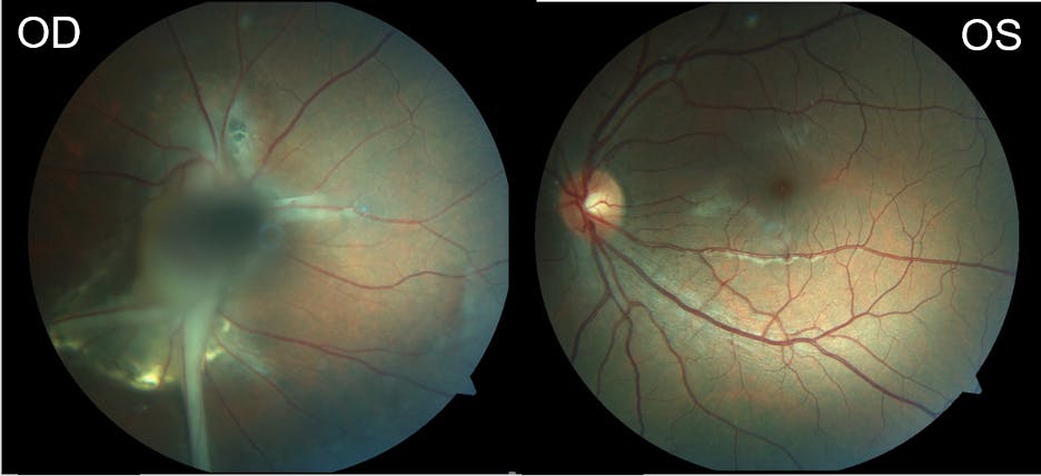 Persistent Fetal Vasculature - Modern Optometry