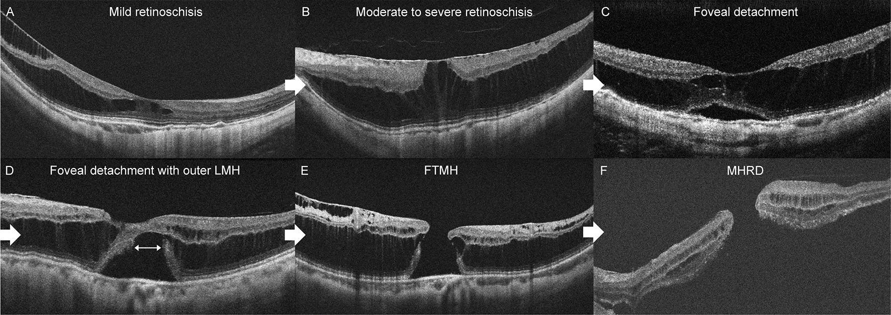 Myopic Traction Maculopathy: Surgical Timing and Techniques - Retina Today