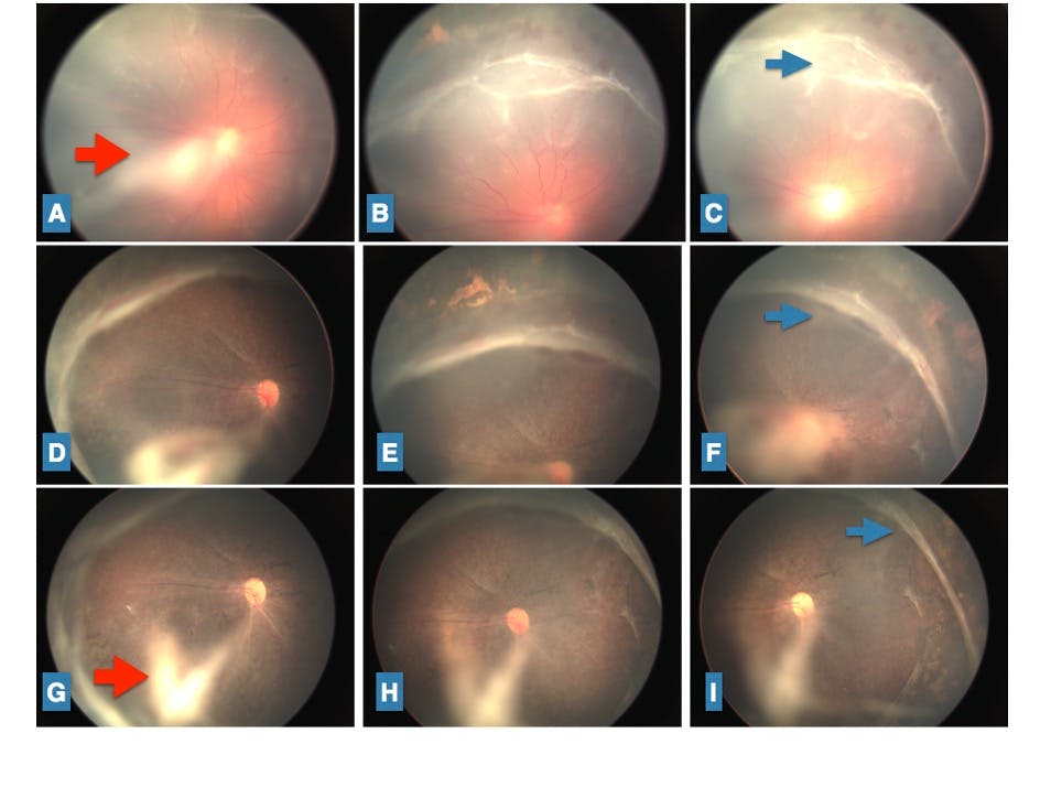 ROP in the OR: When Less is More - Retina Today