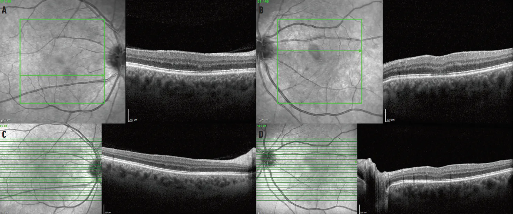 Acute Retinopathy Following Weightlifting Supplement - Retina Today
